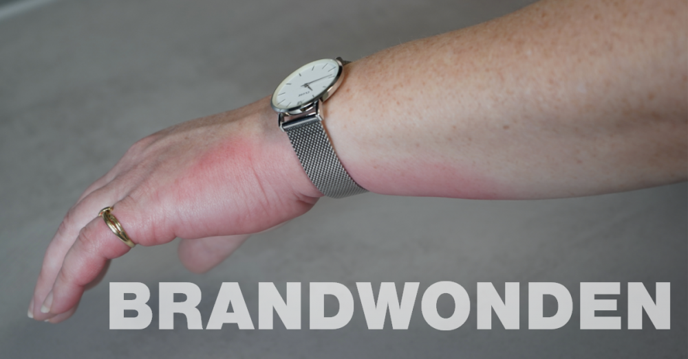 Alles wat je moet weten over brandwonden: van oppervlakkig tot volledig ...